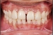 Braces Before & After Pictures | Orthodontic Before & After Results