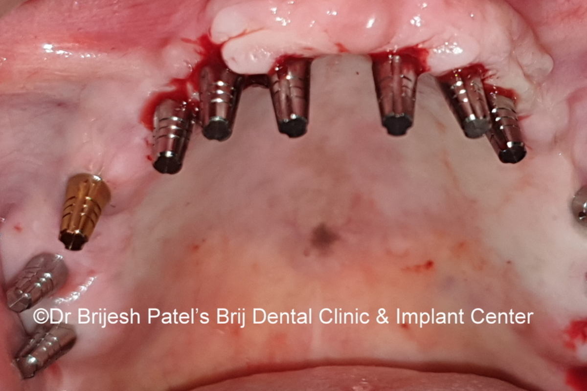 Immediate loading Basal Implants Ahmedabad India | No teeth to fix ...