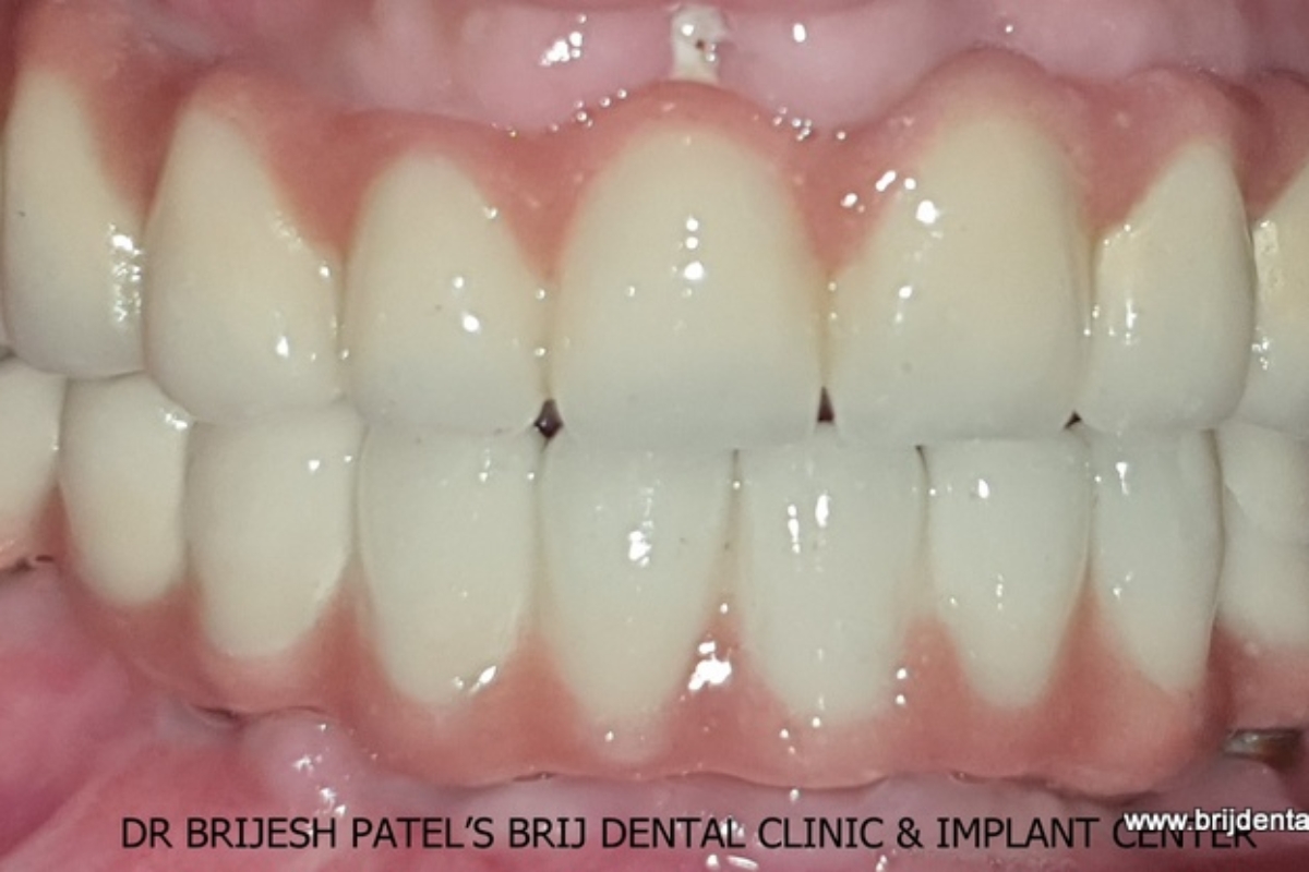Immediate loading Basal Implants Ahmedabad India | No teeth to fix ...