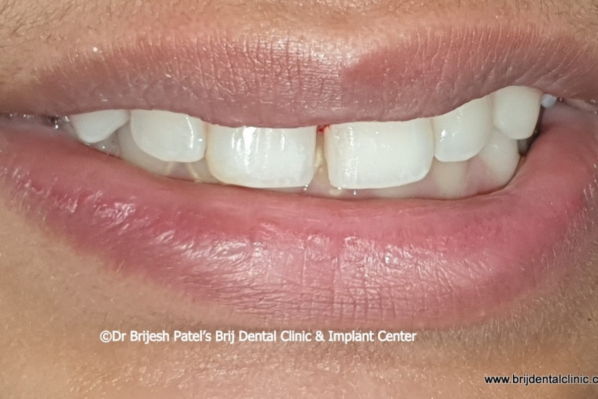 Cosmetic Bonding in Ahmedabad India | Cosmetic dentistry in Ahmedabad