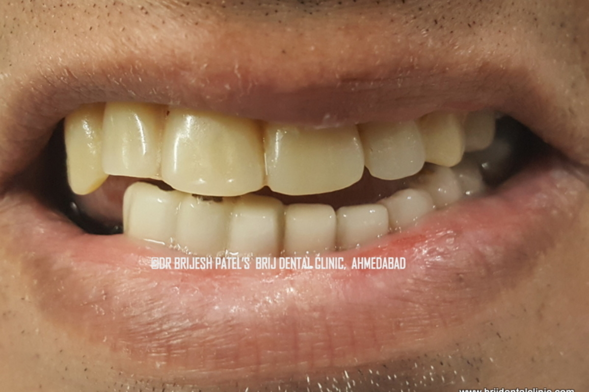 Immediate loading Basal Implants Ahmedabad India | No teeth to fix ...