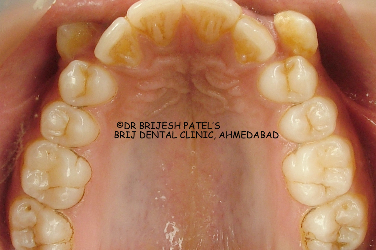 Braces Before & After Pictures | Orthodontic Before & After Results