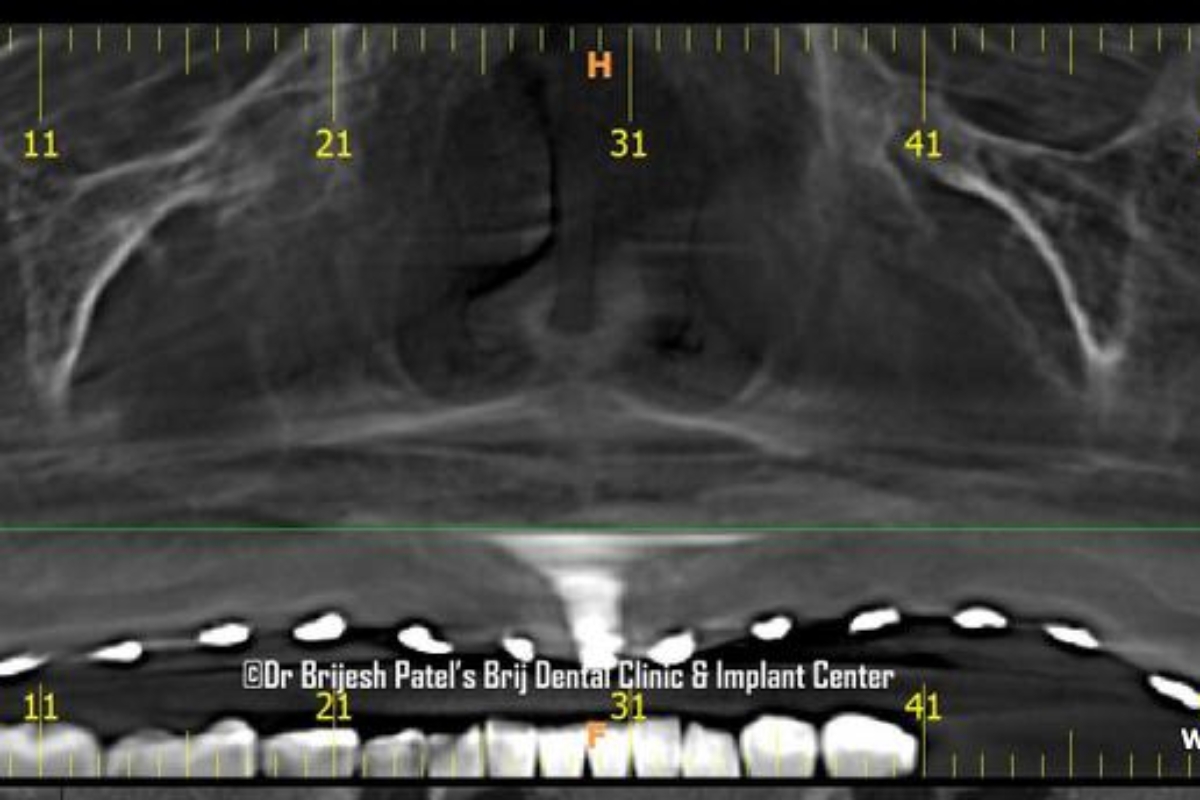 Immediate loading Basal Implants Ahmedabad India | No teeth to fix ...
