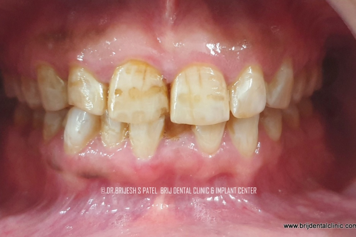 Dental Ceramic or Porcelain Veneers Before And After Photos in ...