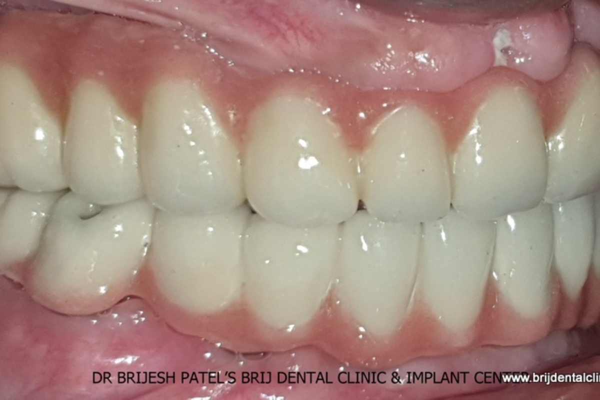 Immediate loading Basal Implants Ahmedabad India | No teeth to fix ...