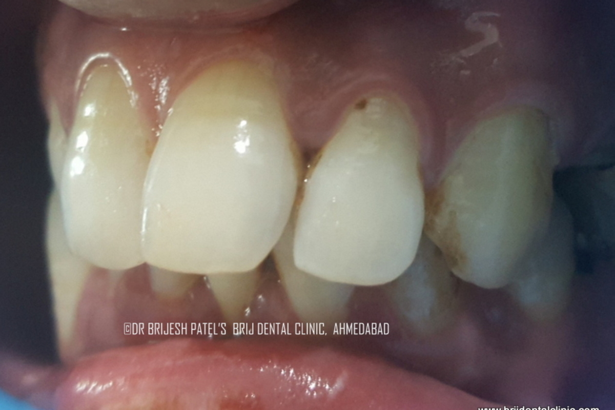 Ceramic Zirconia Crown & Tooth Capping Ahmedabad
