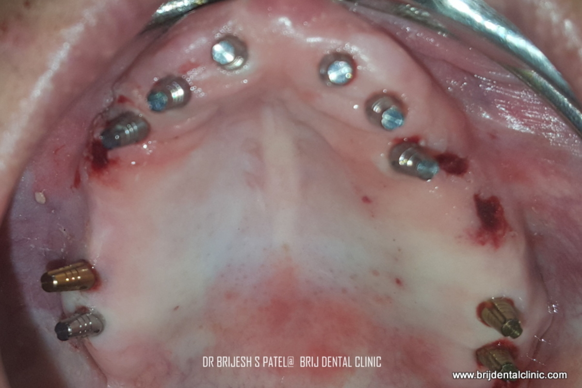 Immediate loading Basal Implants Ahmedabad India | No teeth to fix ...