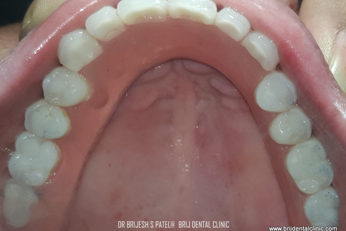 Immediate loading Basal Implants Ahmedabad India | No teeth to fix ...