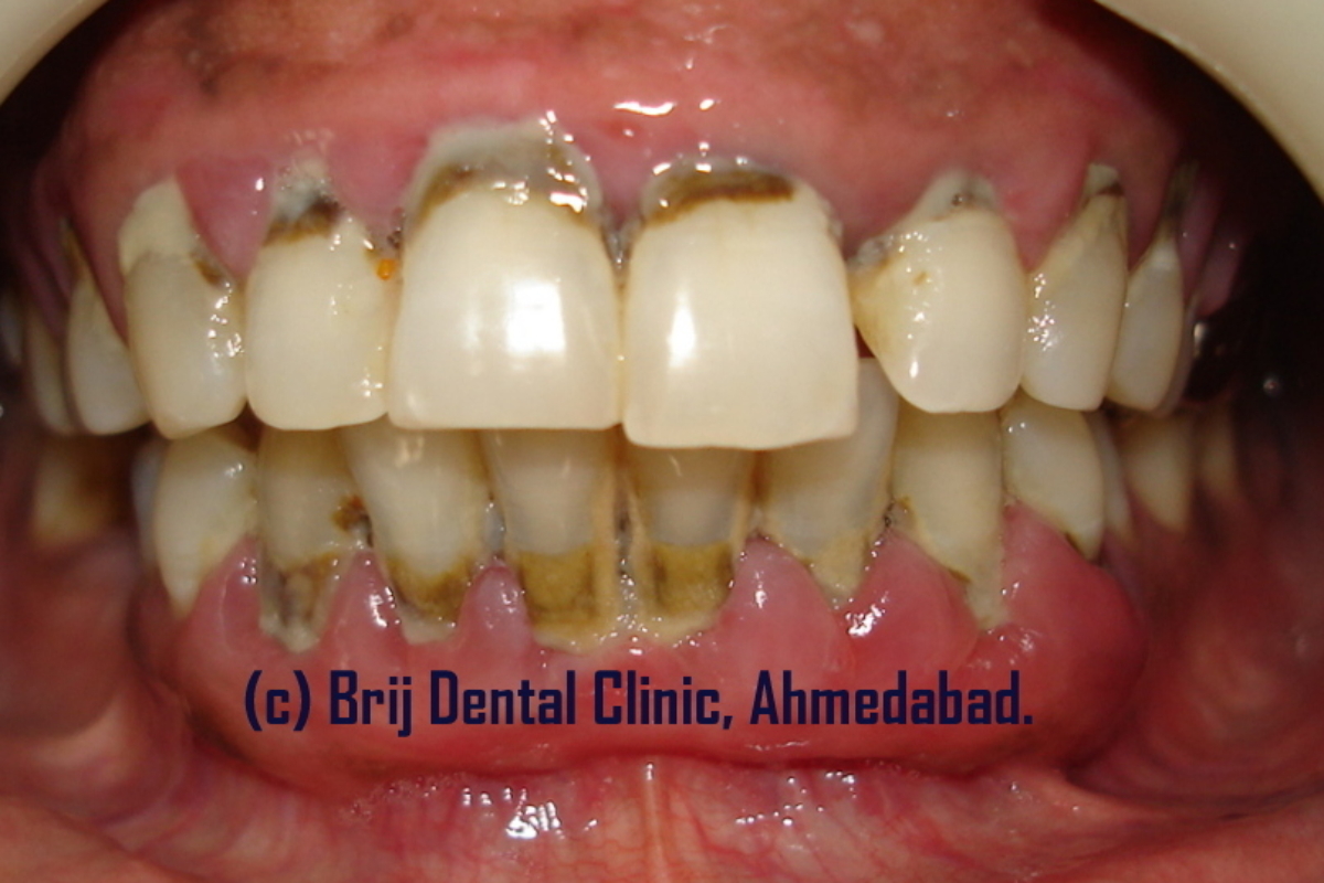 Laser Dental Treatment- Gums, Cavities, Minor Surgeries, RCT in ...