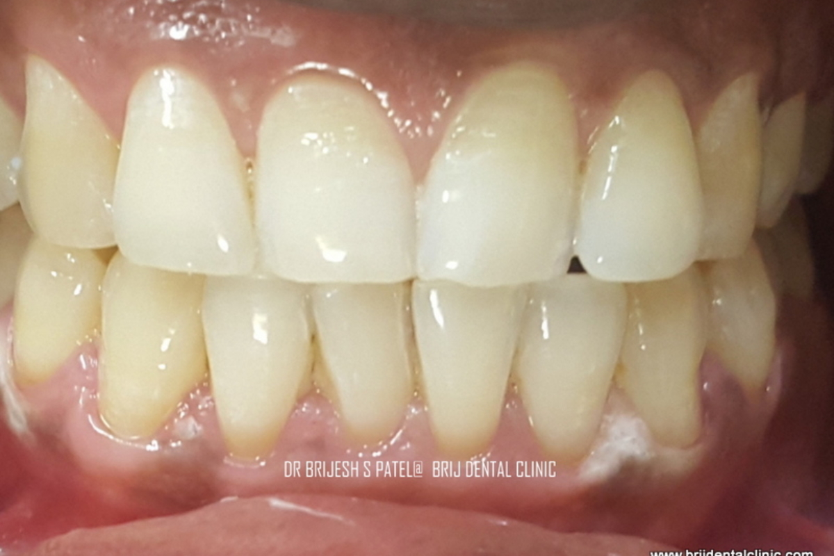 Teeth whitening in Ahmedabad Gujarat India | Laser Teeth Whitening