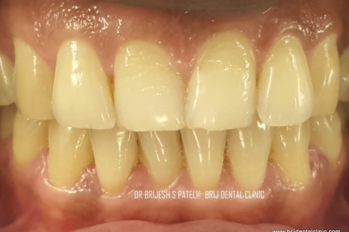 Teeth whitening in Ahmedabad Gujarat India | Laser Teeth Whitening