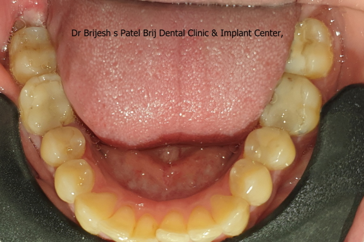 Invisible Clear Aligners (No Braces) Cost in Ahmedabad India