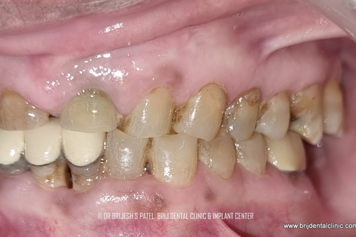 Full Mouth Rehabilitation in Ahmedabad India | Zirconia Ceramic